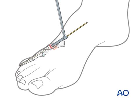 Intramedullary K Wire Fixation For Distal Fractures Of The 5th Metatarsal