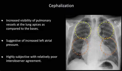 Tags Cxr