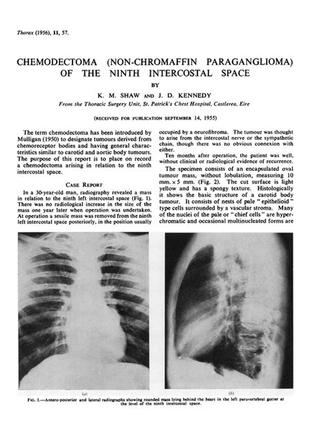 Chemodectoma Non Chromaffin Paraganglioma Of The Ninth Intercostal