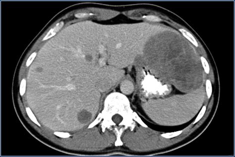 The Radiology Assistant Small Bowel Tumors