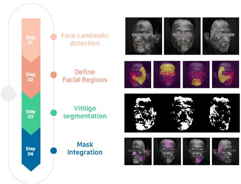 Automated Assessment Of Facial Vitiligo Using Multi View Uv Images And