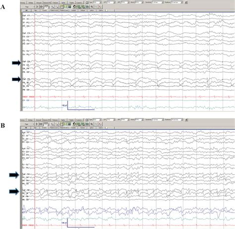 EEG Of Patient 3 Showing Right Fronto Temporal LPDs A Shown In Solid Download Scientific