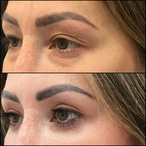 Upper Blepharoplasty Before And After Photos Flora Levin Md