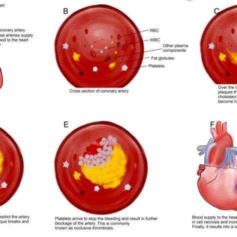 Pdf Staphylokinase A Potent Thrombolytic Agent
