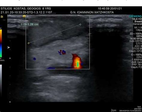 Figure 2 From Rare Case Of Radial Artery Pseudoaneurysm Protruding