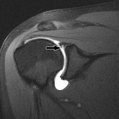 3 T Mri Of The Shoulder Is Mr Arthrography Necessary Ajr