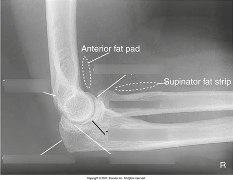 Lateral Elbow Diagram Quizlet