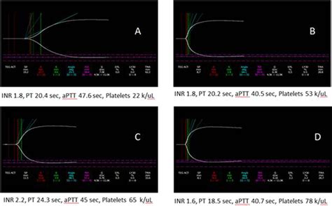 Teg During Defibrotide Therapy With Corresponding Abnormal Rct A At