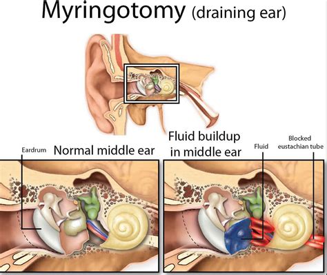 Myringotomy Procedure Myringotomy Tubes Placement Risks And Recovery