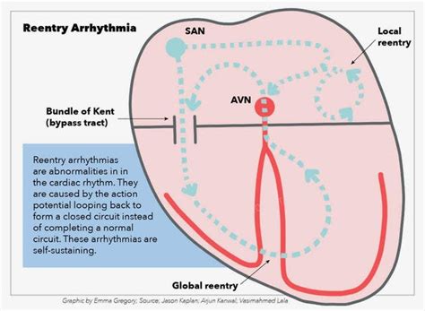 Reentry Arrhythmia Md Searchlight