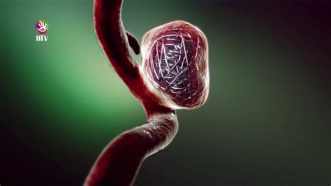 Цүлхэн өвчний шинж тэмдэг Youtube