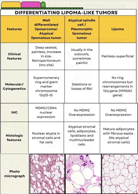 Spindle Cell Lipoma Vs Liposarcoma At Terrance Olson Blog