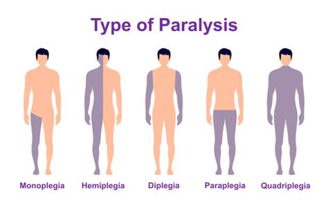 110 Arm Paralysis Stock Illustrations Graphiques Vectoriels Libre De