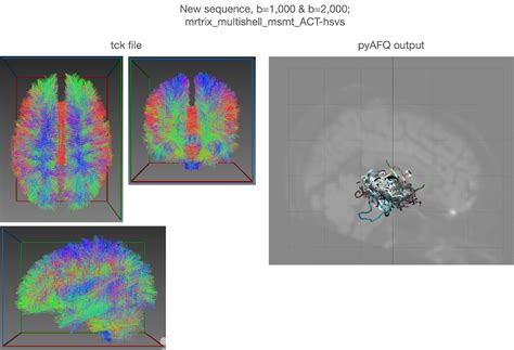 Fiber Tracts Clustered Around Midbrain Issue Yeatmanlab PyAFQ GitHub