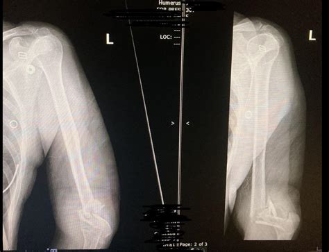 Humerus Fx Distal 13 Rradiology