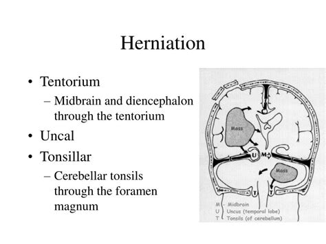 Ppt Increased Intracranial Pressure Powerpoint Presentation Free