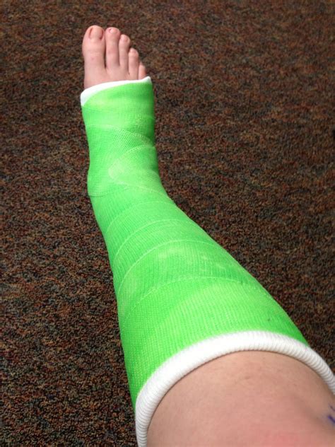 My Broken Ankle Two Weeks Post Op With Cast