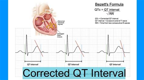 Qtc Interval Long Qt Syndrome By G Dhillon Openpediatrics