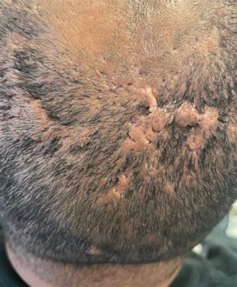 Dermdx Pink Nodules Of The Scalp Dermatology Advisor