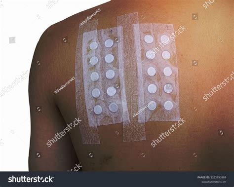 Applying Patch Test Test Chronic Allergic Stock Photo Shutterstock