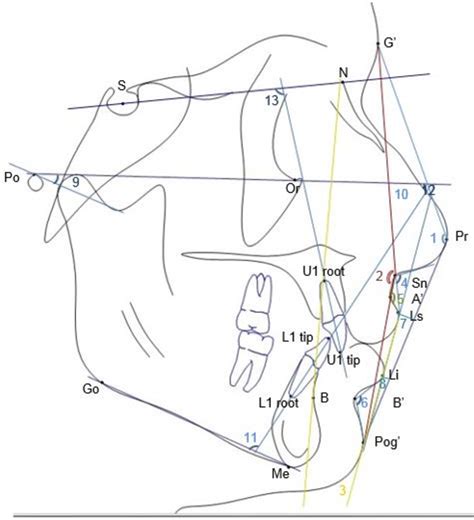 Figure 1 From Long Term Soft Tissue Profile And Incisor Angulation Of Class I And Ii Cases