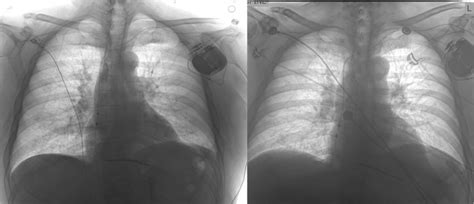 Chest Radiograph Cxr Left Post Implantable Download Scientific