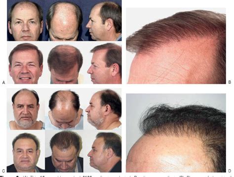 Figure 2 From Scalp Reconstruction And Repair Semantic Scholar