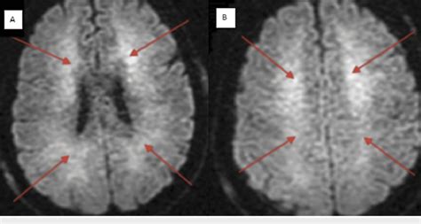 Brain MRI Showing A Diffuse Abnormal DWI Signal In A Subcortical Manner Download Scientific