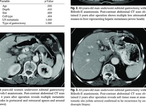 Prognostic Factors Affecting Recurrence Of Early Gastric Cancer Download Scientific Diagram