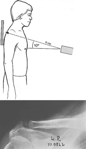 Fractures Flashcards Quizlet