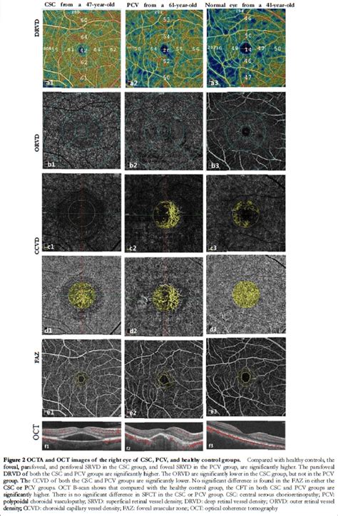 Comparison Of Macular And Choroidal Capillary Vessel Density Between