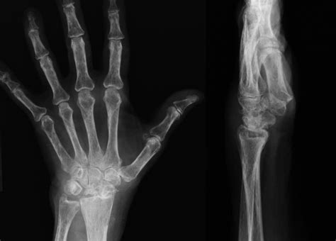 Successful Treatment Of Scapholunate Advanced Collapse A Case Report Pmc