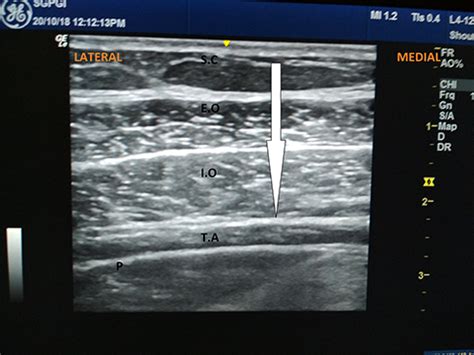 Anesthetic Techniques Focus On Transversus Abdominis Plane Tap Bloc