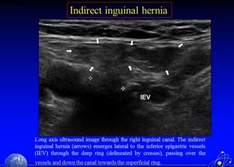 Femoral Hernia Ultrasound Protocol