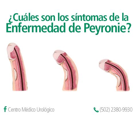 Centro Medico Urologico Continuando Con El Tema De La Enfermedad De