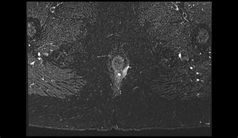 Perianal Fistula Mri Radiology Article On Perianal Fistula Mri