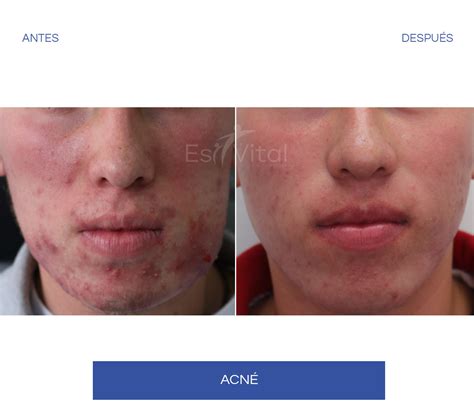 Bioestimulación Corporal Con Sculptra Esvital Center