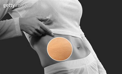 Girl Pulls The Skin On The Abdomen Showing The Body Fat Stretch Marks