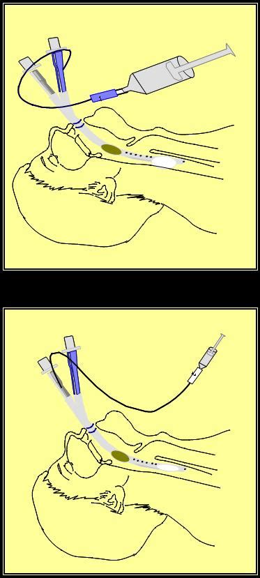 Проба комбитьюб