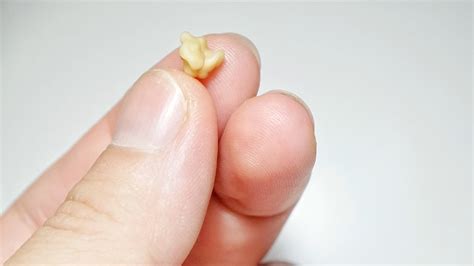 Heres What You Need To Know About Tonsil Stones Vipdailygagme