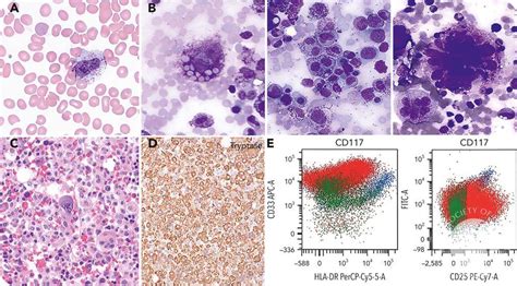 A Challenging Case Of Mast Cell Sarcoma Primarily Involving The Bone Marrow