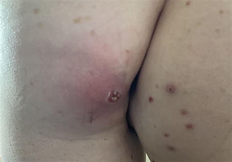 Carbuncle On Butt Ft Butt Pimples Rpopping