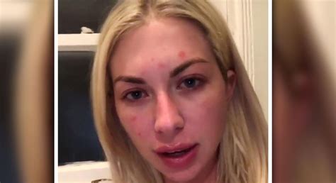 Stassi Schroeder Reveals Psoriasis Make Up Free Photo