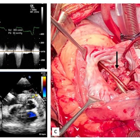 A 2d Echocardiography Continuous Wave Doppler Showing Gradient Of 50