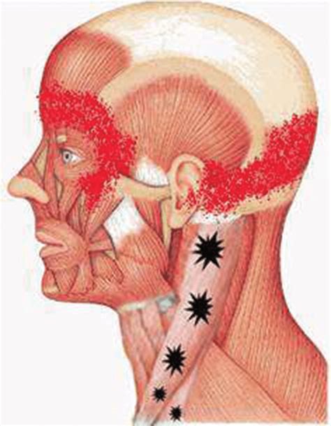 Complications Of Trigger Point Injection Anesthesia Key