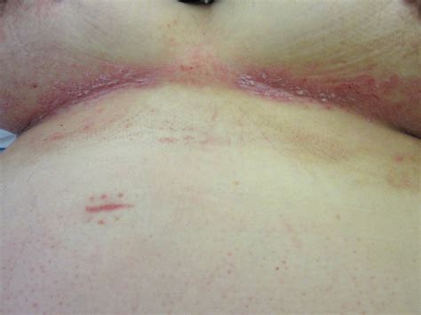 Intertrigo Smetplekken Intertrigineus Eczeem