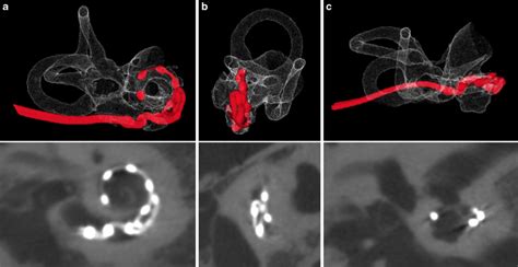 Case 4 25 Year Old Patient With Looped Intracochlear Electrode Array Download Scientific
