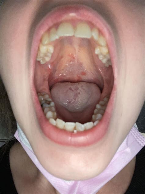 Hello 2 Weeks Ago I Had Unprotected Sex Last Week I Was Told I Have