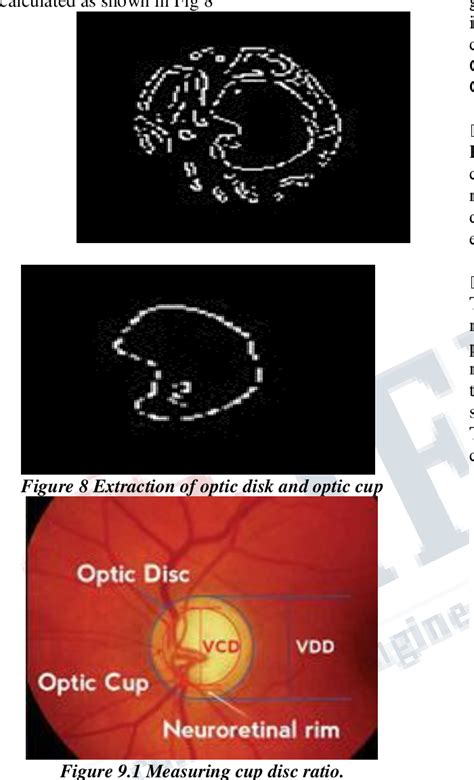 Figure 8 From Glaucoma Detection And Its Classification Using Fuzzy C Means And K Means