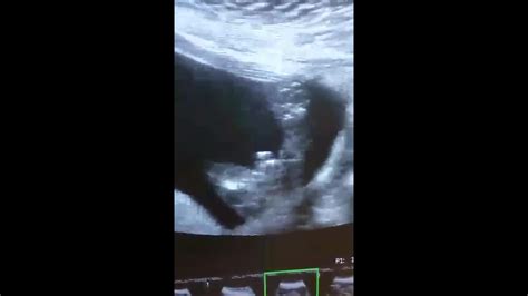 کلیپ برای جنین پسر سونوگرافی